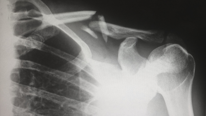 ‘Bandage’ to rebuild broken bones and speed up the healing process ...
