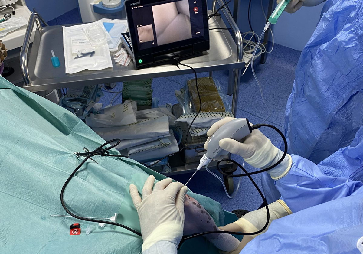 Needle Arthroscopy: Minimally invasive technique