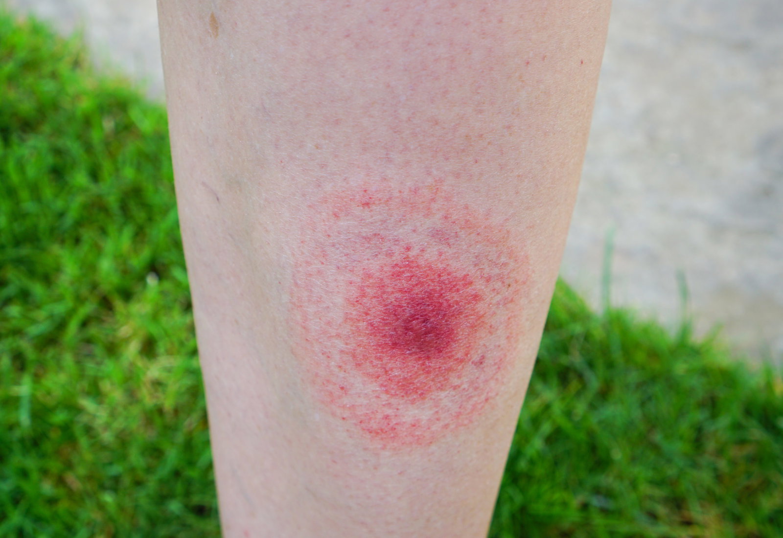 Explainer: Lyme disease, how do you get it and what to look for « Euro ...