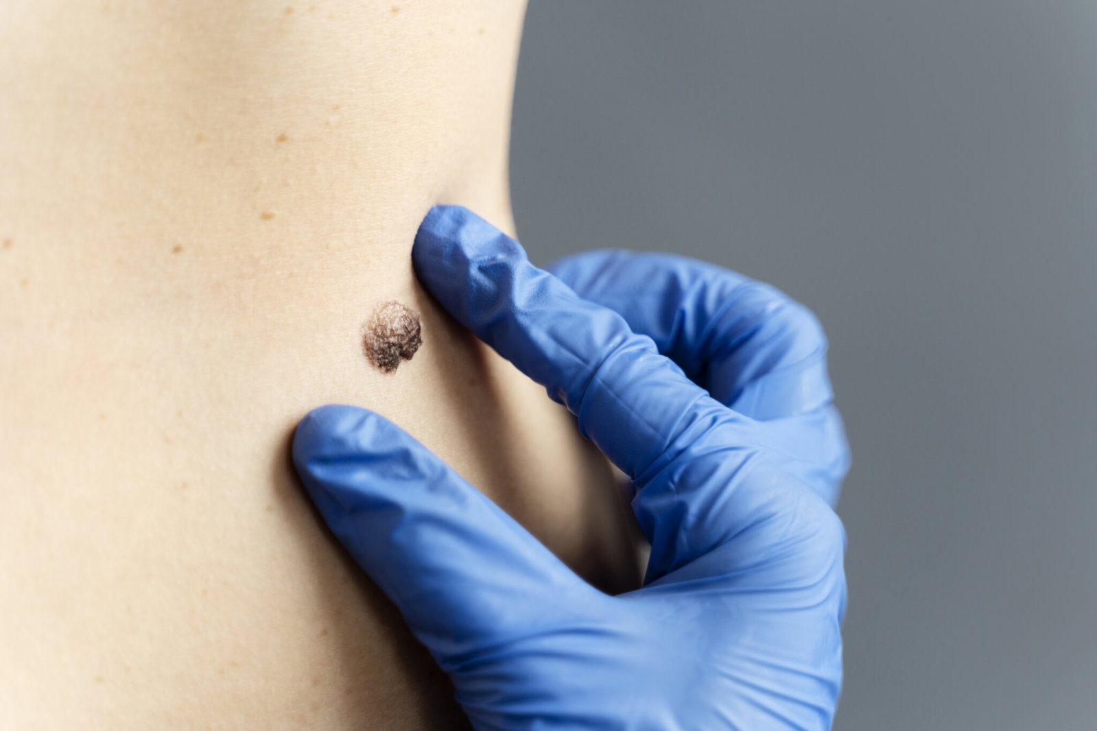 Everything you should know about skin tag removal procedures in London